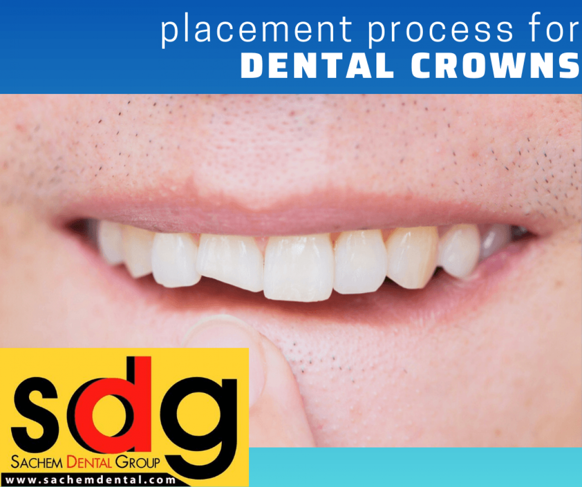 Placement of Dental Crowns - Sachem Dental Group