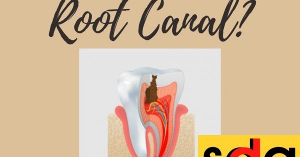 Why Do I Need a Root Canal if My Tooth Doesn’t Hurt? - Sachem Dental Group