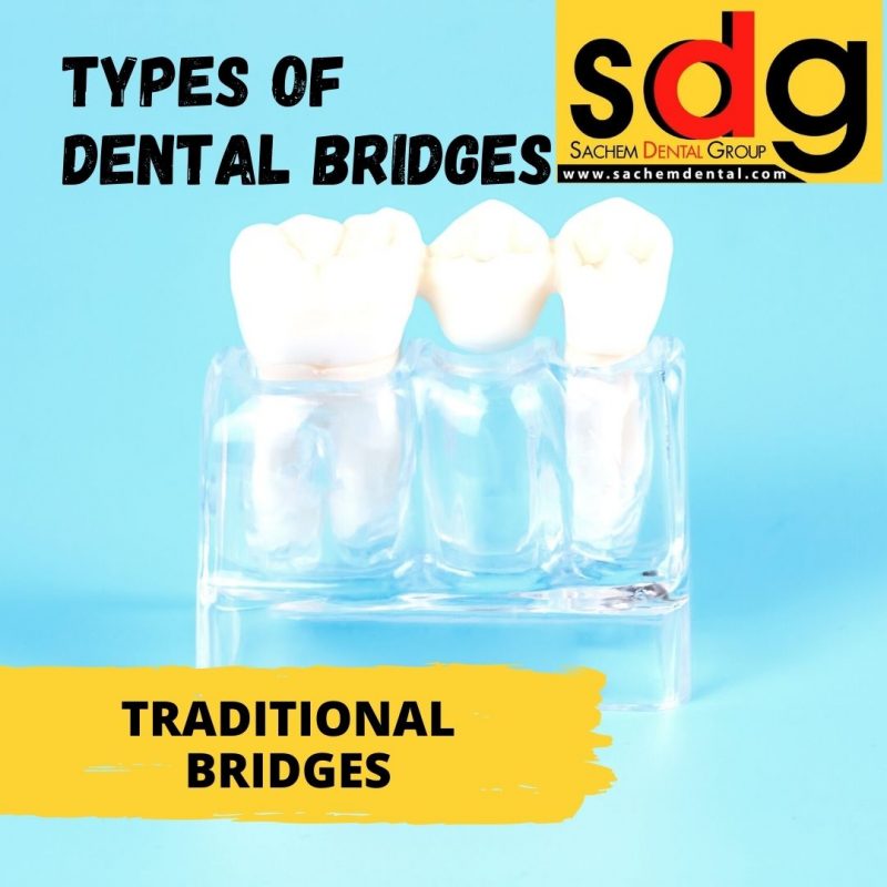 Traditional Dental Bridge - Sachem Dental Group