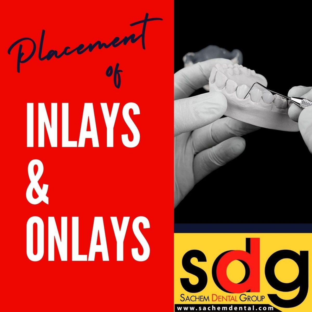 Placement of Inlays and Onlays - Sachem Dental Group