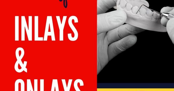 Placement of Inlays and Onlays - Sachem Dental Group