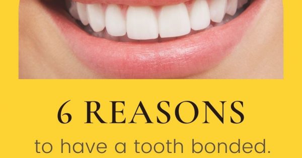 Dental Bonding: 6 Reasons to Get a Tooth Bonded - Sachem Dental Group