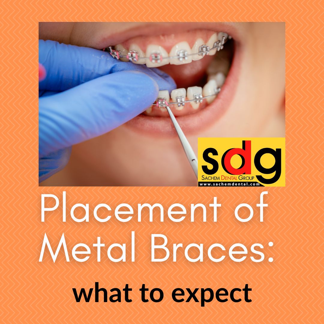 The Placement of Metal Braces: What to Expect